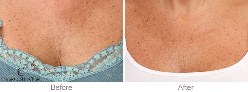 Hands & Chest treatments, reduce ageing lines with Restylane Vital